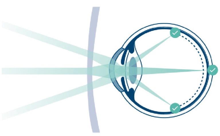 Presentamos Mycon de Rodenstock – Revista Ver+